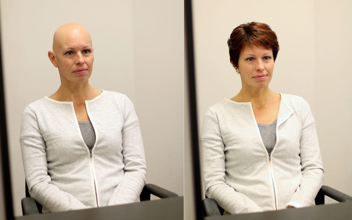 Alopecia - Laat Alopecia behandelen door een echte specialist